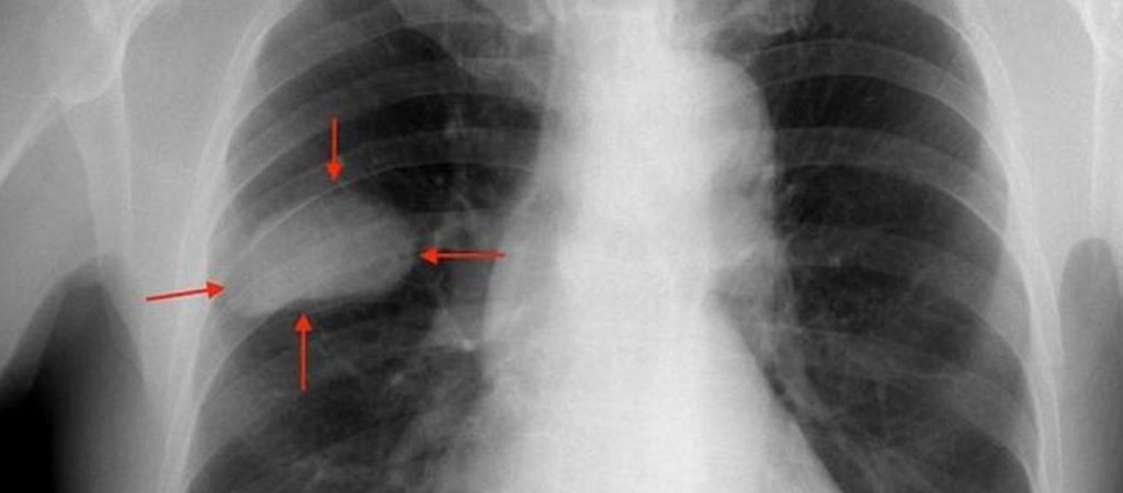 Cáncer de Pulmón – Cirugía Cardíaca y Cirugía Torácica