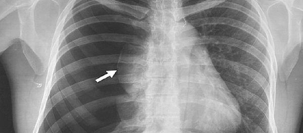 Neumotórax – Cirugía Cardíaca y Cirugía Torácica