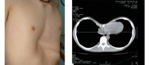 Pectus Excavatum – Cirugía Cardíaca y Cirugía Torácica